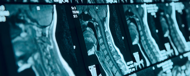 What Does An MRI Of The Cervical Spine Show American Health Imaging